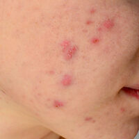Accutane | Saguaro Dermatology | Phoenix Arizona